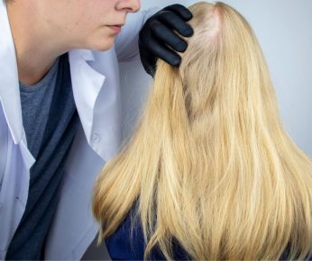 Alopecia Universal en hombres y mujeres: Qué es + Causas